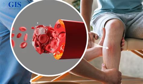 Emerging Trends In Leukapheresis Market Forecast 2024 2033 Linkewire