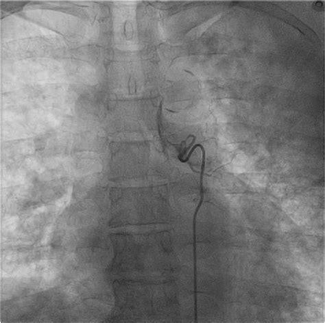 Post Embolization With 500 μm Pva Particles Selective Intercostal Download Scientific Diagram