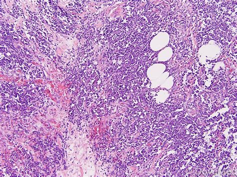 Aids Associated Burkitt And Burkitt Like Lymphoma