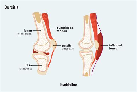 Bursitis Symptoms Types Treatment And More