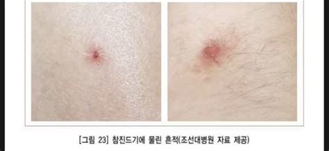 진드기 물렸을때 물린자국 증상 퇴치 방법 고열 홍반 Sfts 양성