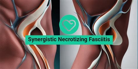 Synergistic Necrotizing Fasciitis Causes Symptoms And Treatment