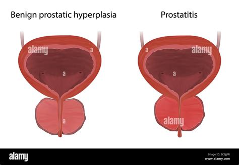 Comparison Of Benign Prostatic Hyperplasia And Prostatitis Illustration Prostatitis Is The