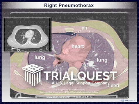 Right Pneumothorax Trial Exhibits Inc