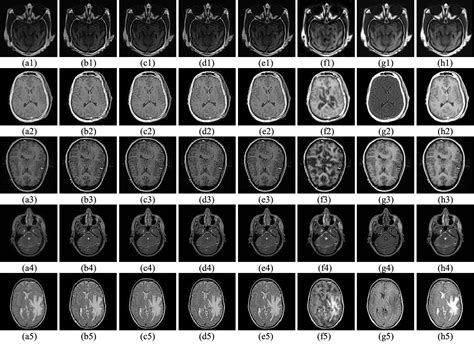 Figure 6 From Multimodal Sensor Medical Image Fusion Based On Type 2 Fuzzy Logic In Nsct Domain