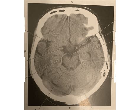 Axial Ct Of Ambient Suprasellar Interpeduncular Quiz