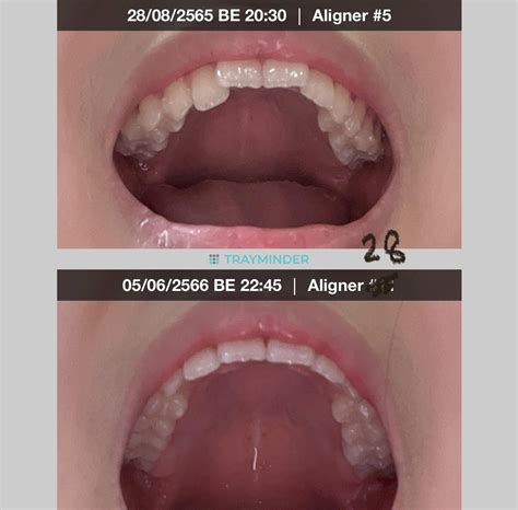 28 Trays Of Progress 5 More To Go R Invisalign