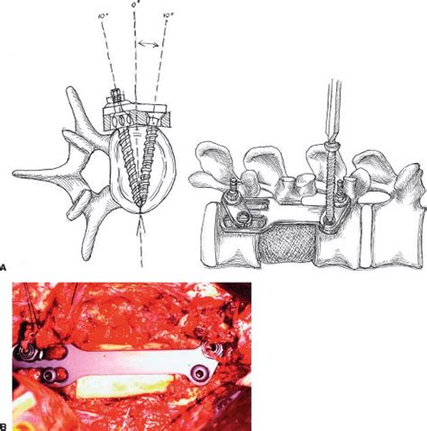 Thoracic Decompression And Instrumented Fusion Techniques Musculoskeletal Key