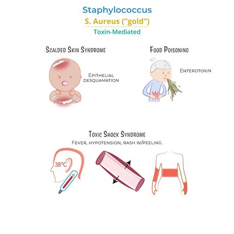 Toxic Shock Syndrome Diagram Bilder Und Videos Suchen Scheide