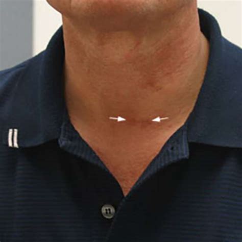 High Calcium Levels And Primary Hyperparathyroidism Endocrine Surgery