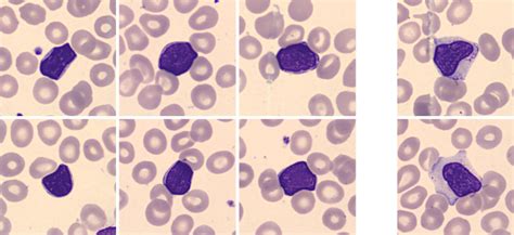 Figure 1 From Deep Multi Instance Learning Using Multi Modal Data For Diagnosis Of Lymphocytosis