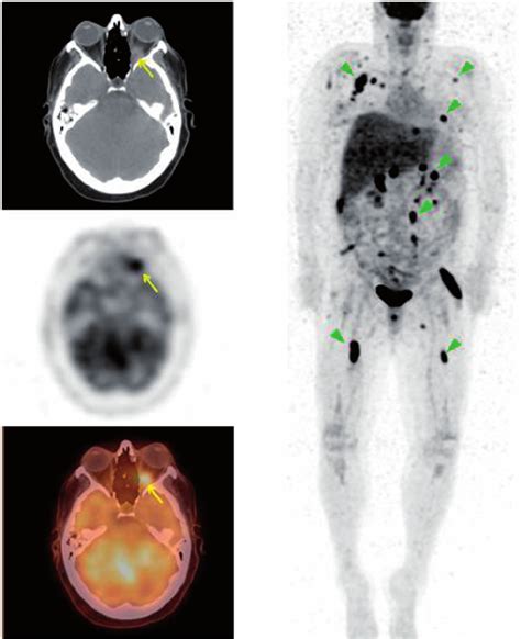 A 52 Year Old Man Presenting With Abdominal Adenopathy And Blastic Bone Download Scientific