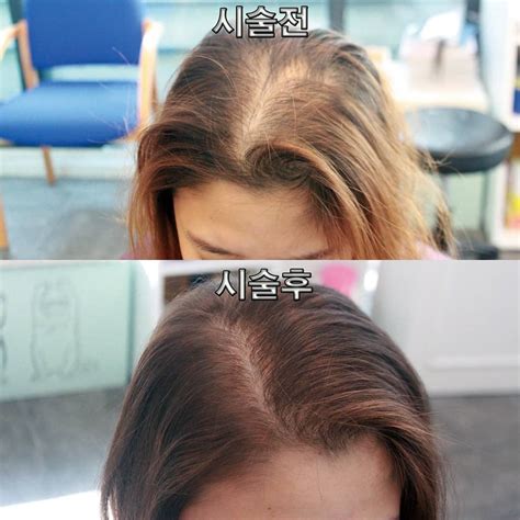 머리에반하다 염색이랑 같이 증모술 하기 순서는 전체 염색 먼저하고 ️ 증모술 했음요