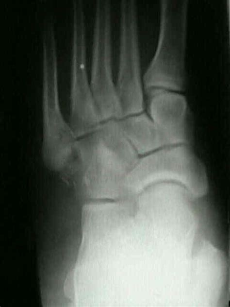Cuboid Fracture Wheeless Textbook Of Orthopaedics