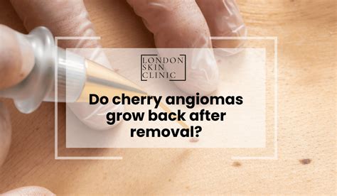 Cherry Angioma Bleeding Causes And Emergency Treatment London Skin