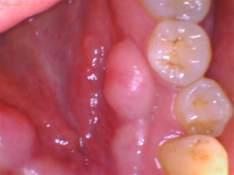 Mandibular Tori Things To Know 1311 Jackson Ave Dental Dentist In