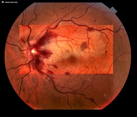 Central Retinal Vein Occlusion Crvo W Cilio Retinal Artery 15 Of 17 Nyee