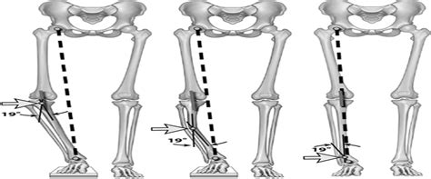The Natural History Of Lower Extremity Malalignment Journal Of