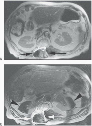 Gradient Echo Part I Basic Principles Radiology Key