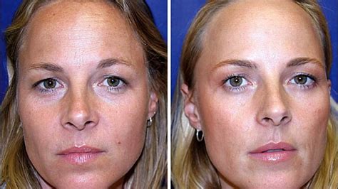 One Identical Twin 38 Had Botox For 20 Years The Other Didn T Who