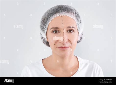 Portrait Of Mature Woman With Marks On Face Preparing For Cosmetic Surgery Against White