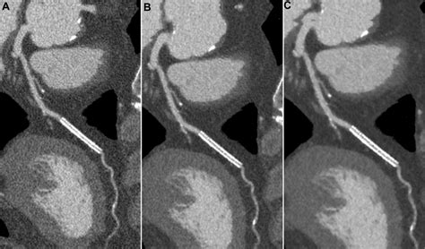 Iterative Reconstruction In Cardiac Ct Journal Of Cardiovascular Computed Tomography