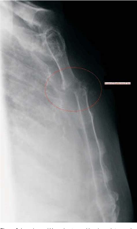 Figure 1 From Manubriosternal Subluxation Dislocation Can Lead To Manubriosternal Septic