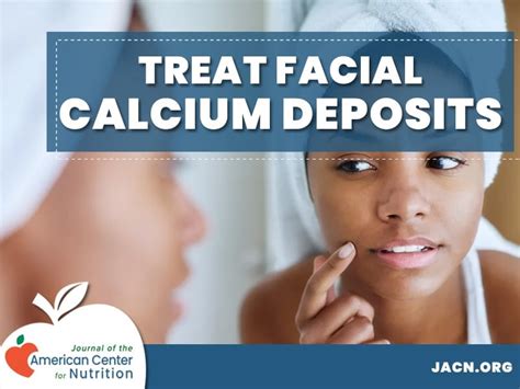 Treatments For Calcium Deposits On The Face Facial Calcinosis Cutis Causes Symptoms And