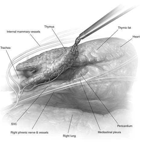 Thoracoscopic Thymectomy Operative Techniques In Thoracic And