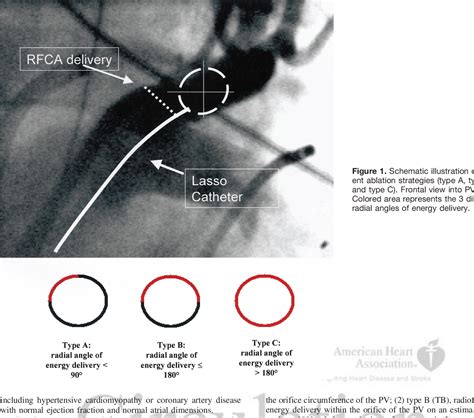 Figure 1 From Three Dimensional Magnetic Resonance Imaging For Paroxysmal Atrial Fibrillation