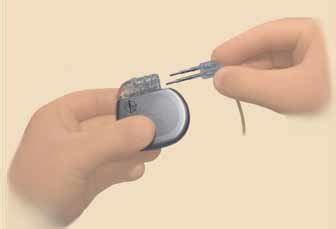 A B C Connection Of The Extensions Wires To The Pulse Generator Download Scientific Diagram