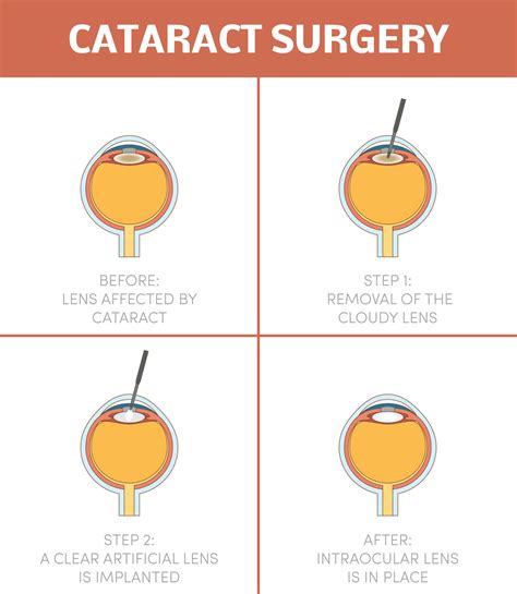 The 4 Types Of Cataract Lenses Eye Care Professionals