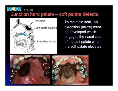 Soft Palate Defect Soft Palate Anatomical Diagram Function And