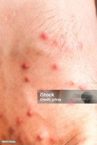 Flea Allergy Dermatitis On Humans