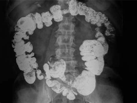 Figure 1 From Intestinal Duplication In Adulthood A Rare Entity Difficult To Diagnose