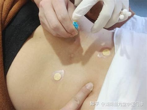 过苗年湖南苗九堂中医门诊：埋线减肥全过程！ 知乎