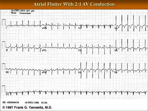 Ppt Electrocardiogram Powerpoint Presentation Free Download Id 649219