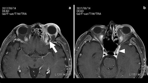 Septische Sinus Cavernosus Thrombose Youtube