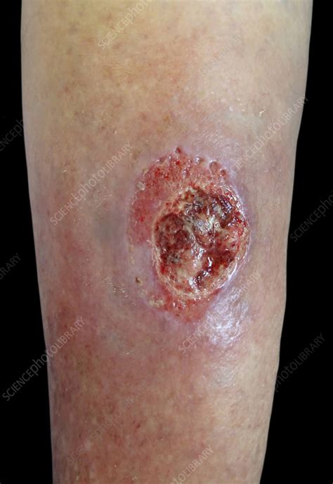 Pyoderma Gangrenosum On A Womans Leg Stock Image C059 0954 Science Photo Library