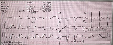Circumflex Artery Occlusion Ecg Guru Instructor Resources