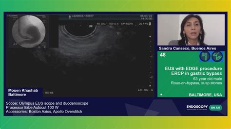 EUS With EDGE Procedure ERCP In Gastric Bypass Endoscopy On Air
