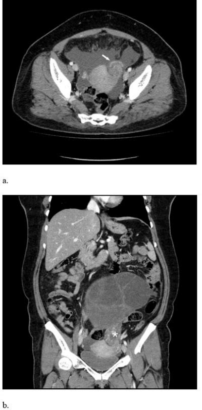 Ovarian Torsion Ultrasound Whirlpool Sign