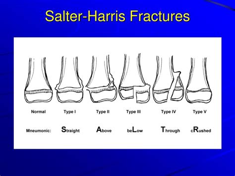 Ppt Describing Fractures Basics Powerpoint Presentation Free
