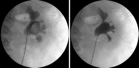 Example Of Retrograde Uretero Pyelography Right Retrograde Download Scientific Diagram