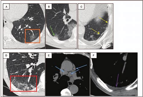 Top 3 Typical And Atypical Ct Findings A Nodular Ground Glass