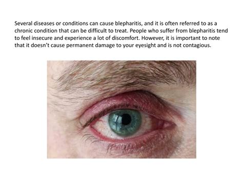 PPT Demodex Blepharitis Treatment PowerPoint Presentation Free Download ID 12042163