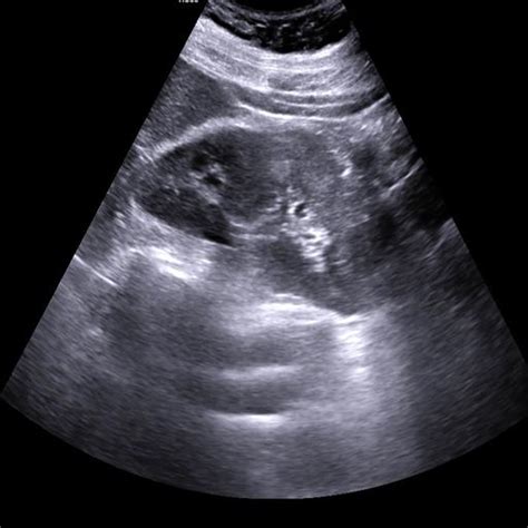 肾结石分类和对象检测数据集 肾结石检测超声图像数据集 含 9416 张原始处理图像 适用于肾结石检测模型训练 医学影像资源 Csdn博客