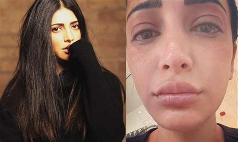 Actress Shruti Haasan With Swollen Face What Happened To The Fans