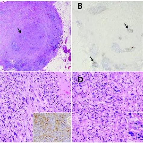 Pdf Interdigitating Dendritic Cell Sarcoma