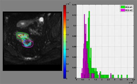 ADC Histogram Comparison Of Two Sub ROIs Although Both Areas Are Download Scientific Diagram